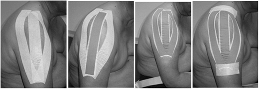 Effectiveness of the California Tri-Pull Taping Method for Shoulder ...